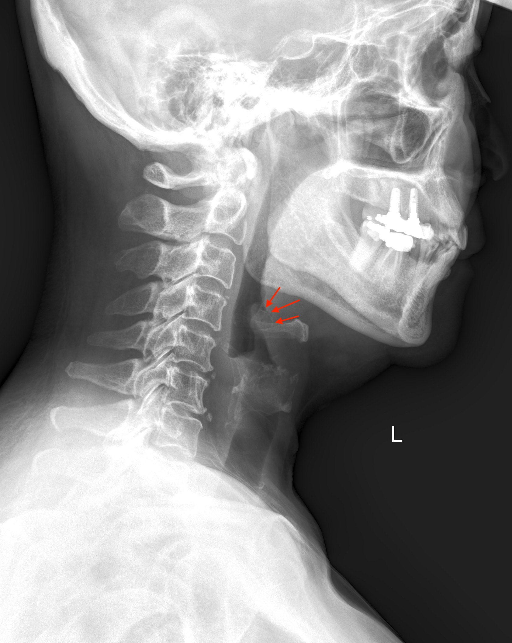 Fish Bones Throat ENT Clinic Fish Bones Throat ENT Clinic
